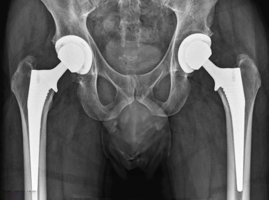 Totale Heupprothese (THP) - ProMove - bewegen & gezondheid : ProMove ...